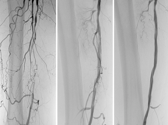 What We Do - Ponosh Vascular