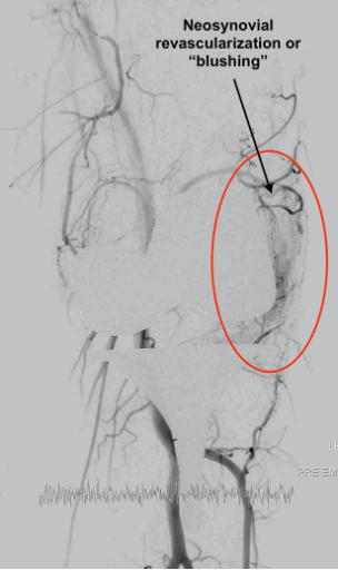Geniculate Embolization For Arthritis and Following Knee Replacement ...