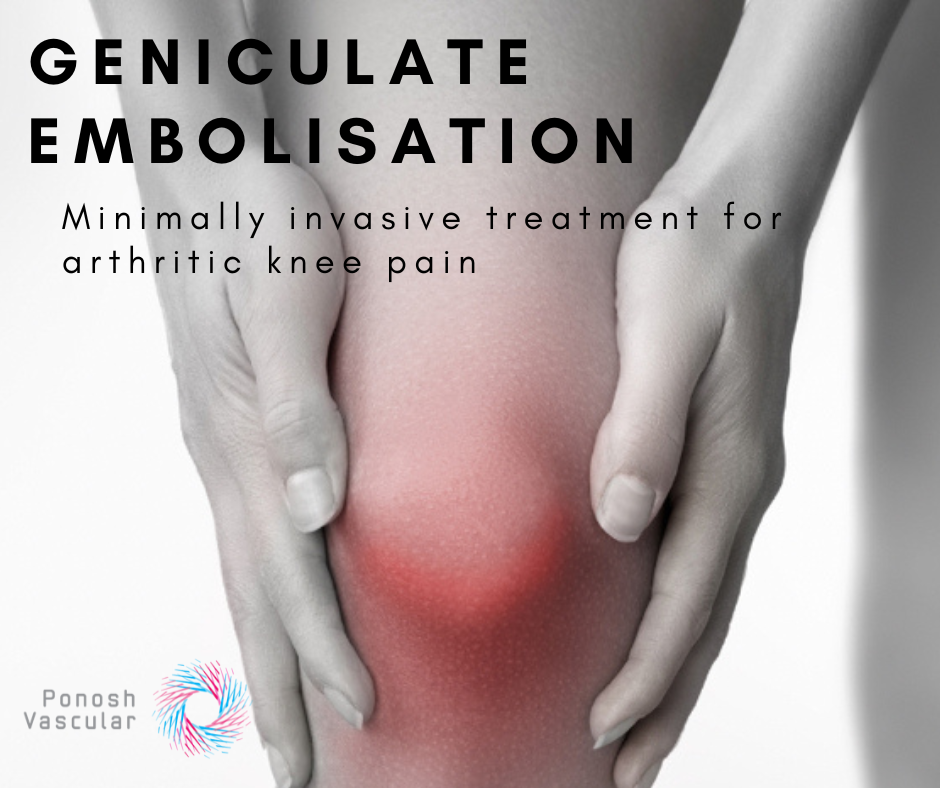Geniculate Embolization - Minimally Invasive Treatment of Arthritic ...